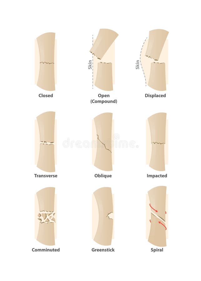 Impacted Fracture Bone. Infographics. Vector Illustration On A Lined ...