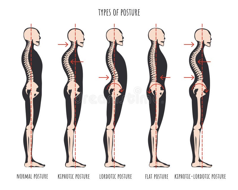 Type of Posture, Postural Syndromes Infographic. Skeletal Samples of ...