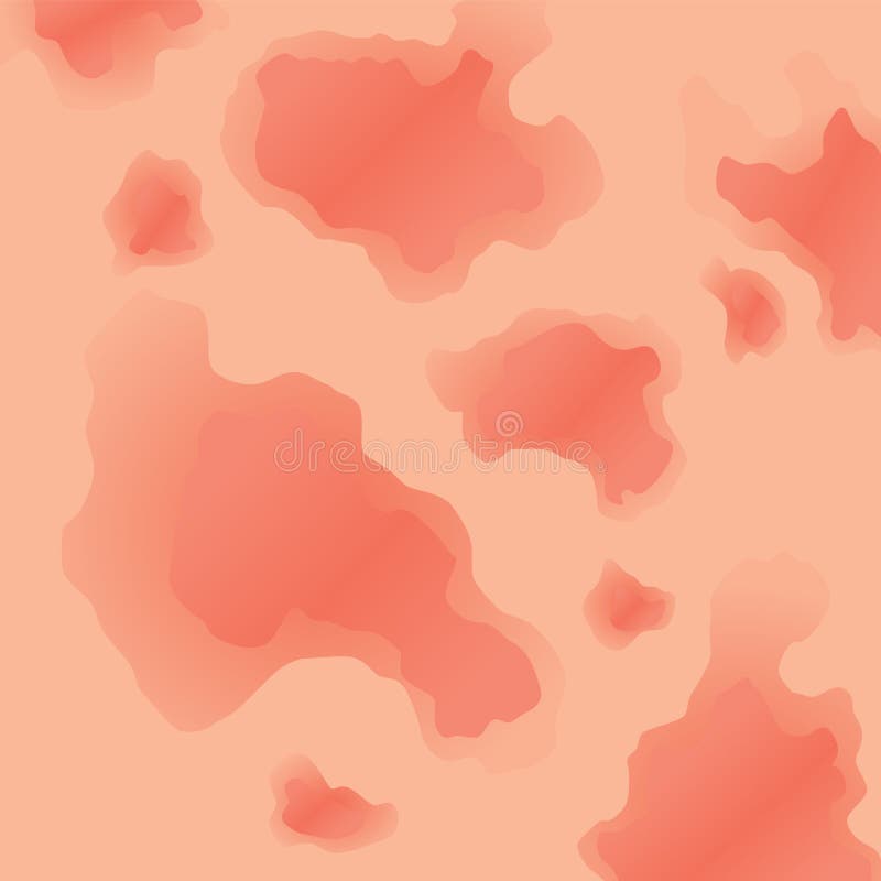 Type of Psoriasis Vector. Part of Patients Skin with Dermatitis ...