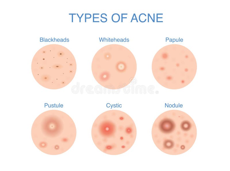 Types Of Acne Diagram