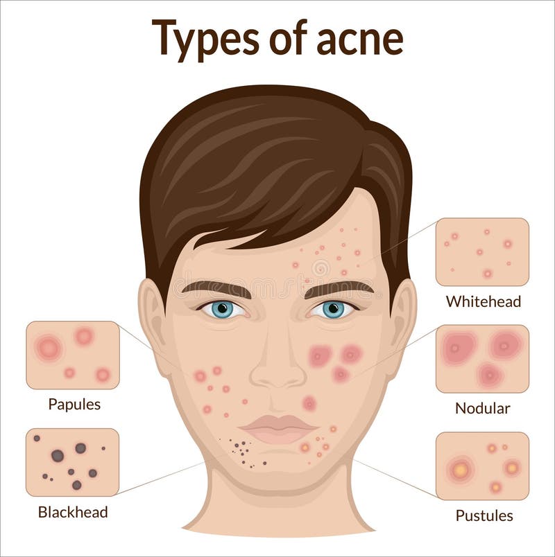 Types of acne stock vector. Illustration of efflorescence - 252889624
