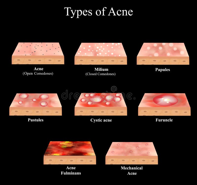Types Of Acne Skin Inflammation Pimples Boils Whitehead Closed