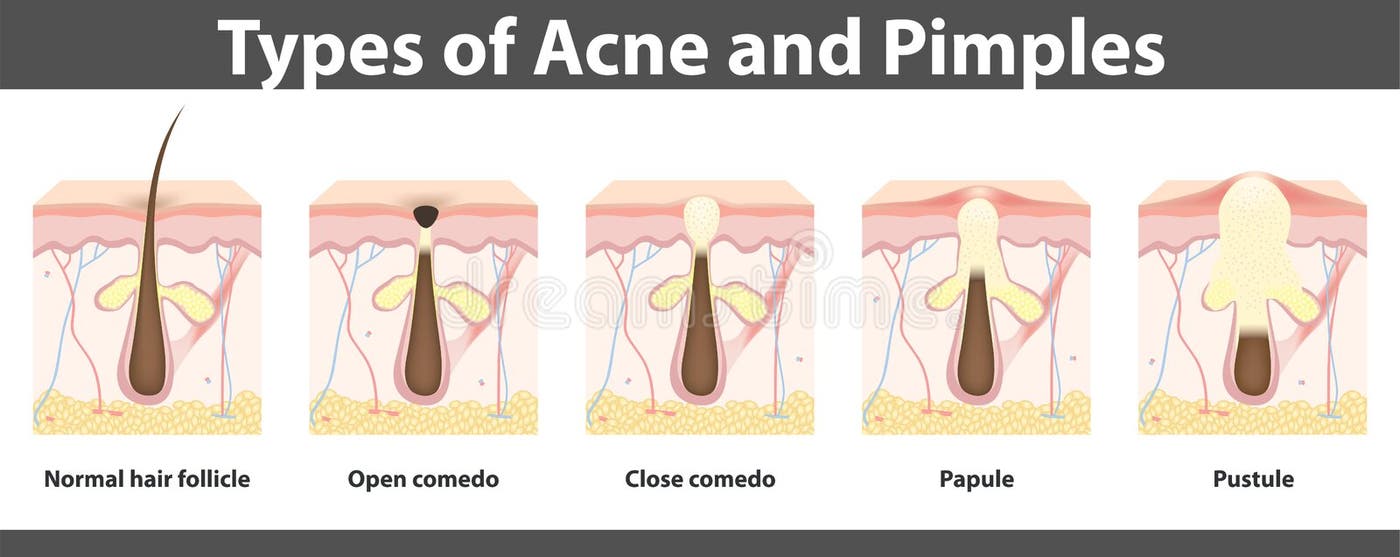 Furuncle Stock Illustrations – 466 Furuncle Stock Illustrations ...