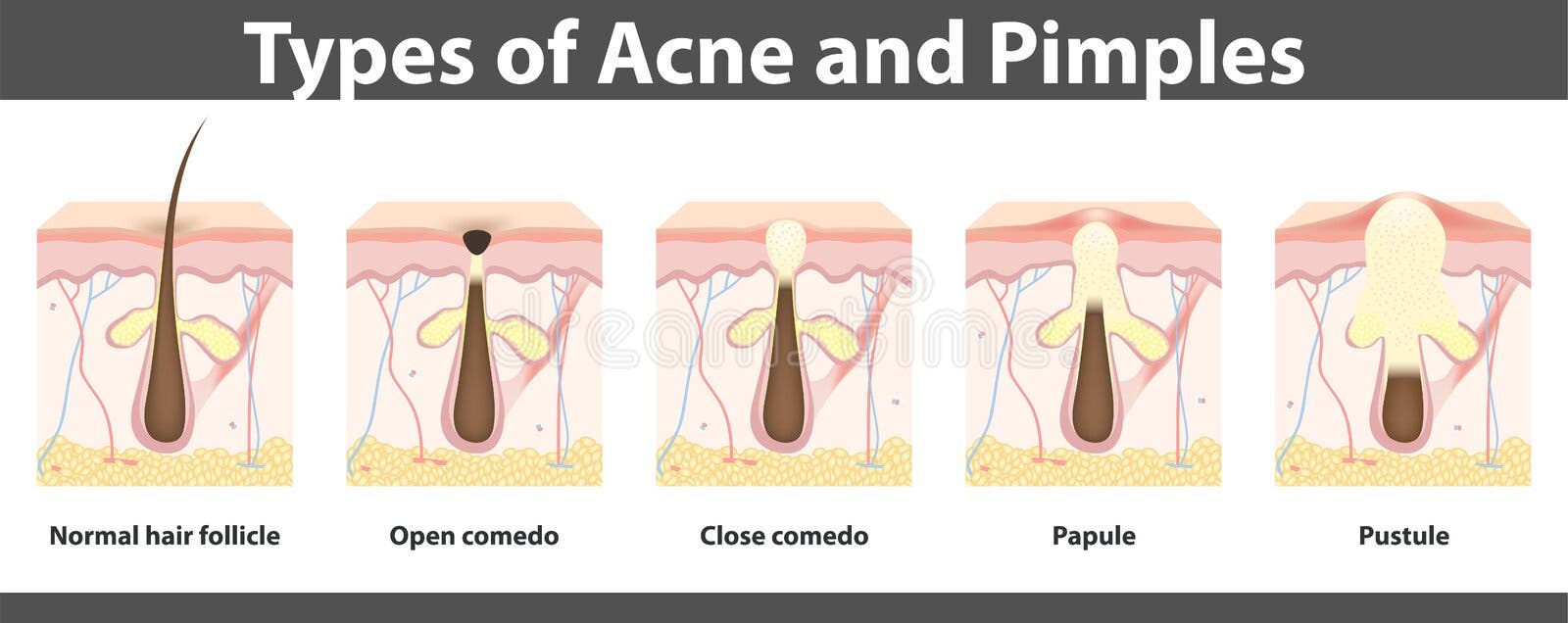 Skin Structure Acne Stock Illustrations – 1,012 Skin Structure Acne ...
