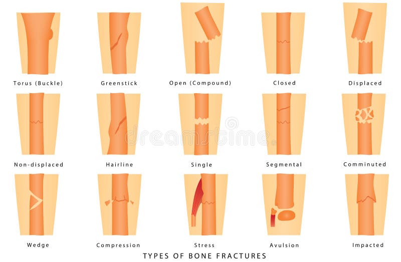 Types of bone fracture stock vector. Illustration of surgery - 186889942