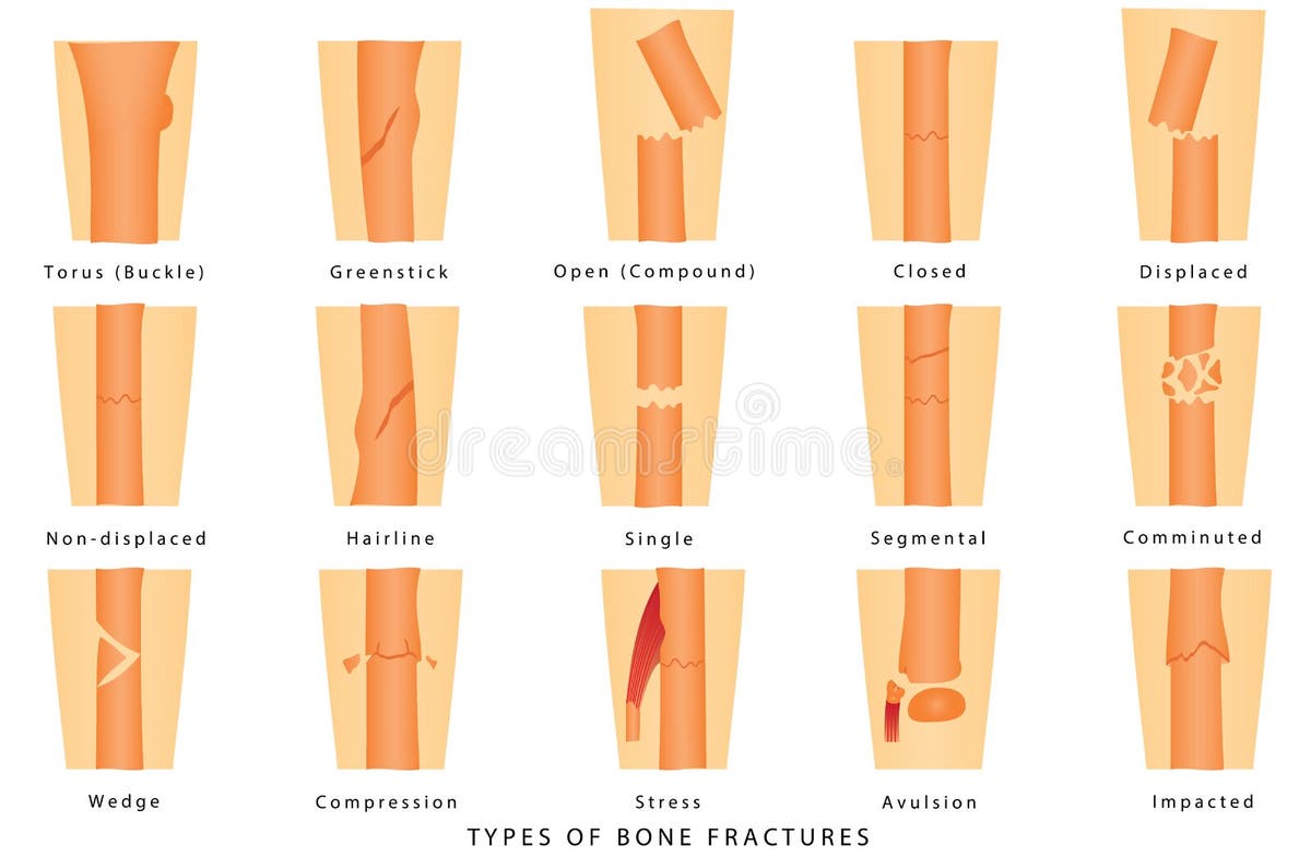Open Fracture Closed Fracture Stock Illustrations – 179 Open Fracture ...