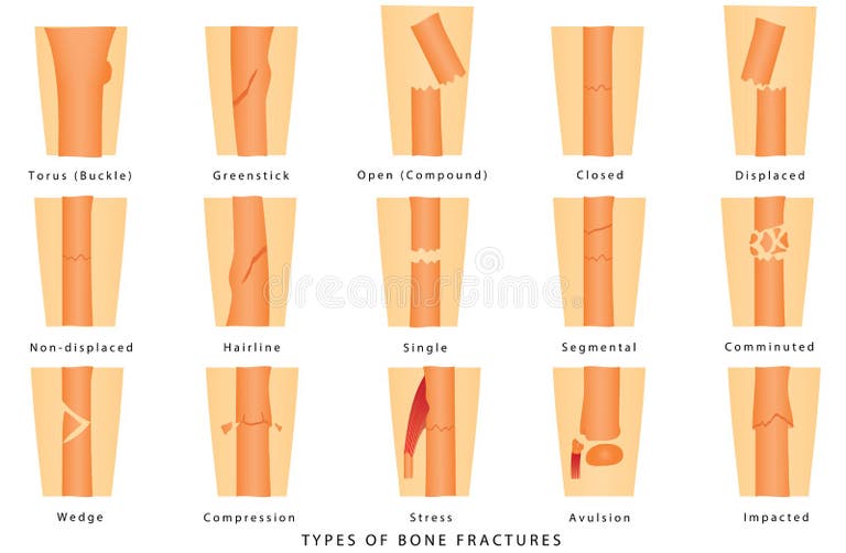 Types of bone fracture stock vector. Illustration of surgery - 186889942