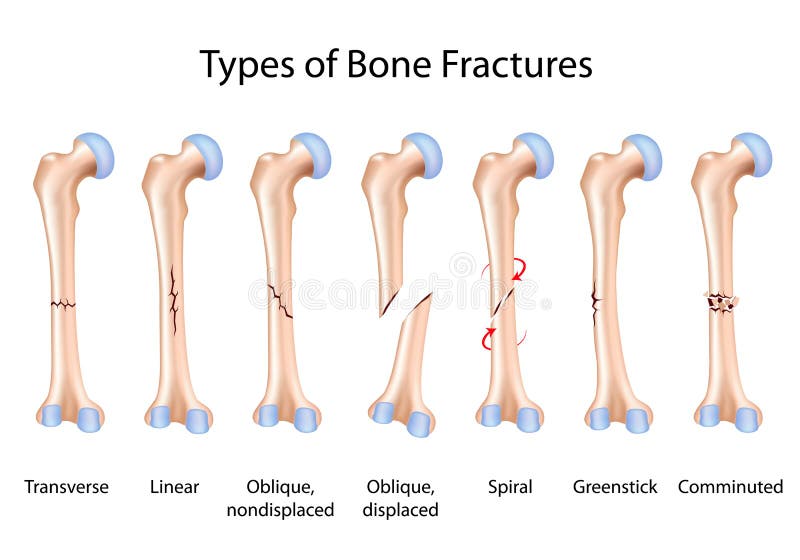 Types of bone fractures stock vector. Illustration of biology - 28110037