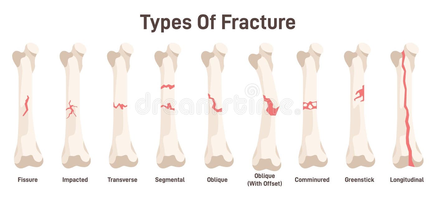 Types Bone Fractures Stock Illustrations – 50 Types Bone Fractures ...