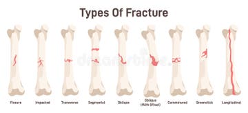 Types of Bone Fractures. Body Injury, Partial or Complete Break Stock ...