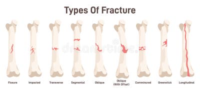 Types of Bone Fractures. Body Injury, Partial or Complete Break Stock ...