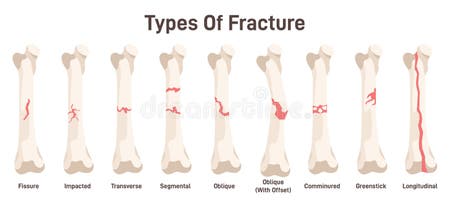 Types of Bone Fractures. Body Injury, Partial or Complete Break Stock ...