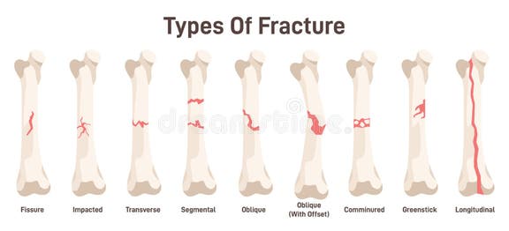 Types of Bone Fractures. Body Injury, Partial or Complete Break Stock ...