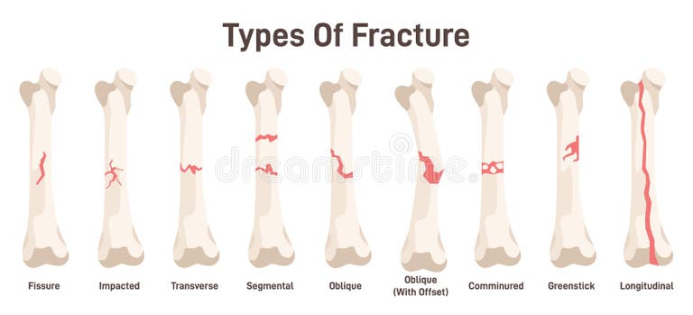 Types of Bone Fractures. Body Injury, Partial or Complete Break Stock ...