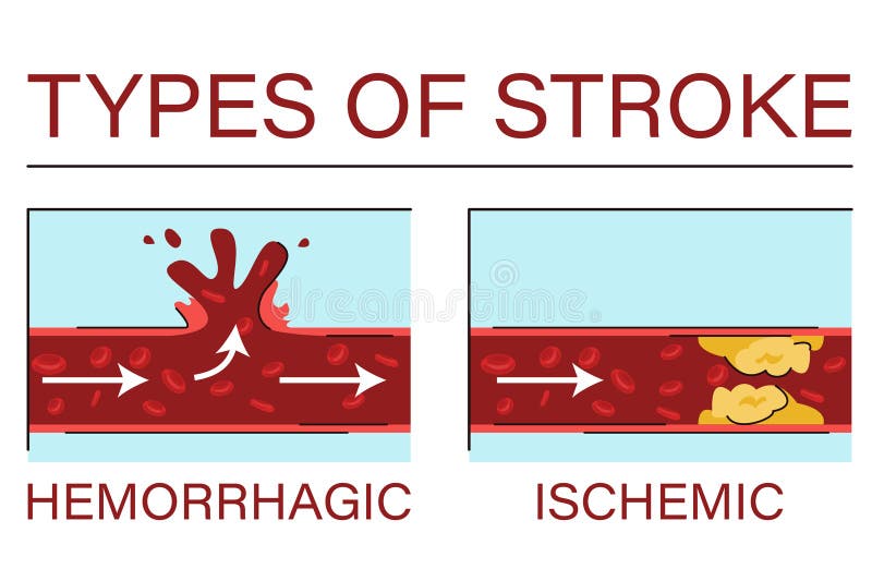 Types of Brain Stroke Vector Isolated Stock Vector - Illustration of ...