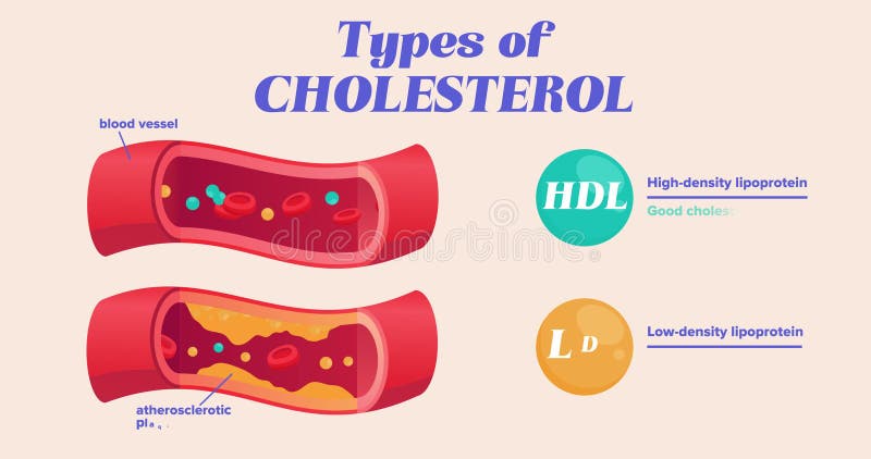 Types of Cholesterol Comparison. Moving Banner with Medical Infographic ... Types of Cholesterol Comparison. Moving Banner with Medical Infographic ...