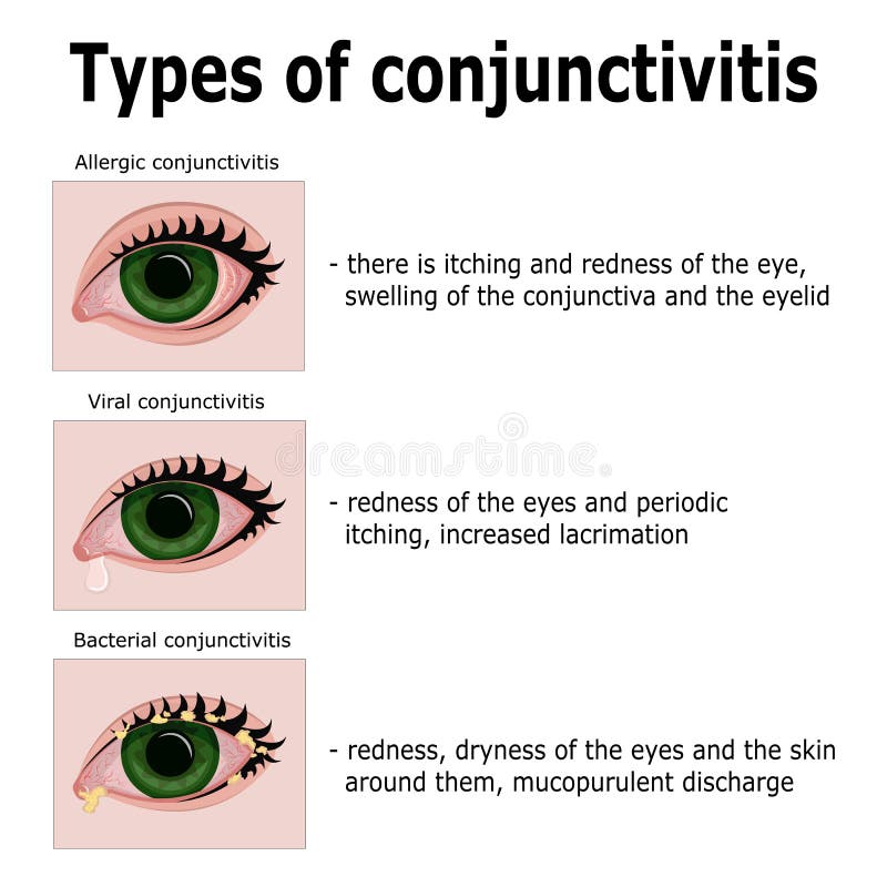 Types of conjunctivitis stock vector. Illustration of purulent - 94545137