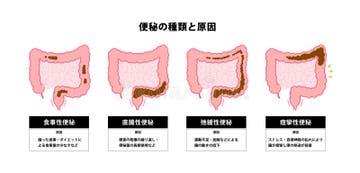 Types of Constipation Vector Illustration Stock Vector - Illustration ...