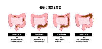 Types of Constipation Vector Illustration Stock Vector - Illustration ...
