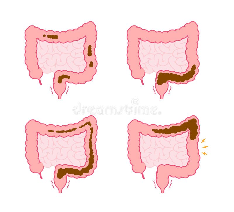 Types of Constipation Vector Illustration Stock Vector - Illustration ...