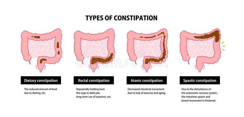 Types of Constipation Vector Illustration Stock Vector - Illustration ...