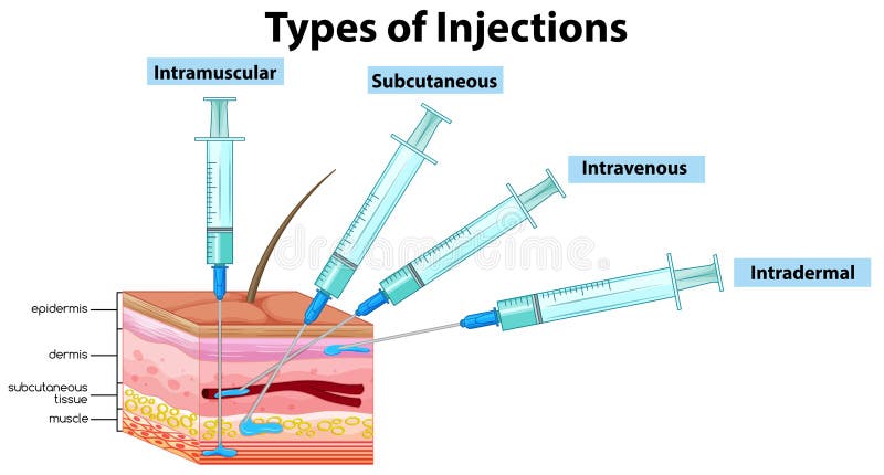 Types D'injections Sur Le Fond Blanc Illustration de Vecteur ...