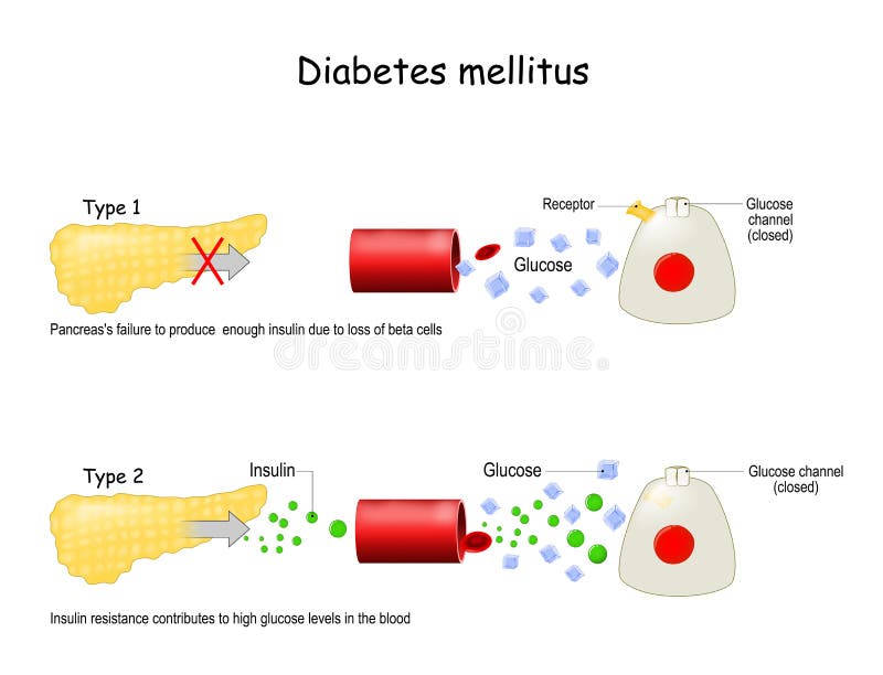Types of Diabetes Simple Medical Vector Illustration Scheme. Health ... Types of Diabetes Simple Medical Vector Illustration Scheme. Health ...