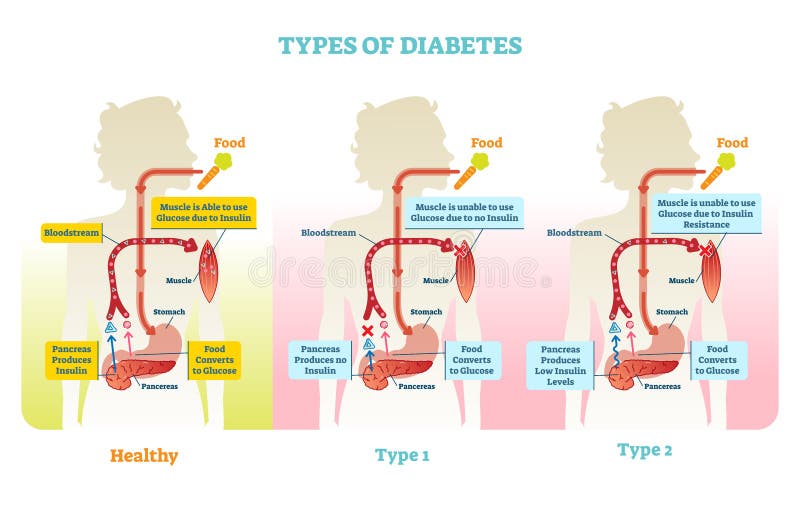Diabetes Stock Illustrations – 35,891 Diabetes Stock Illustrations ...