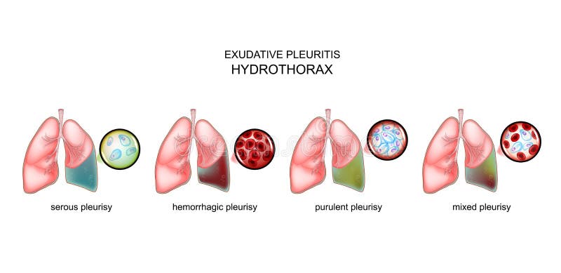 Types of Exudative Pleurisy and Hydrothorax Stock Vector - Illustration ...