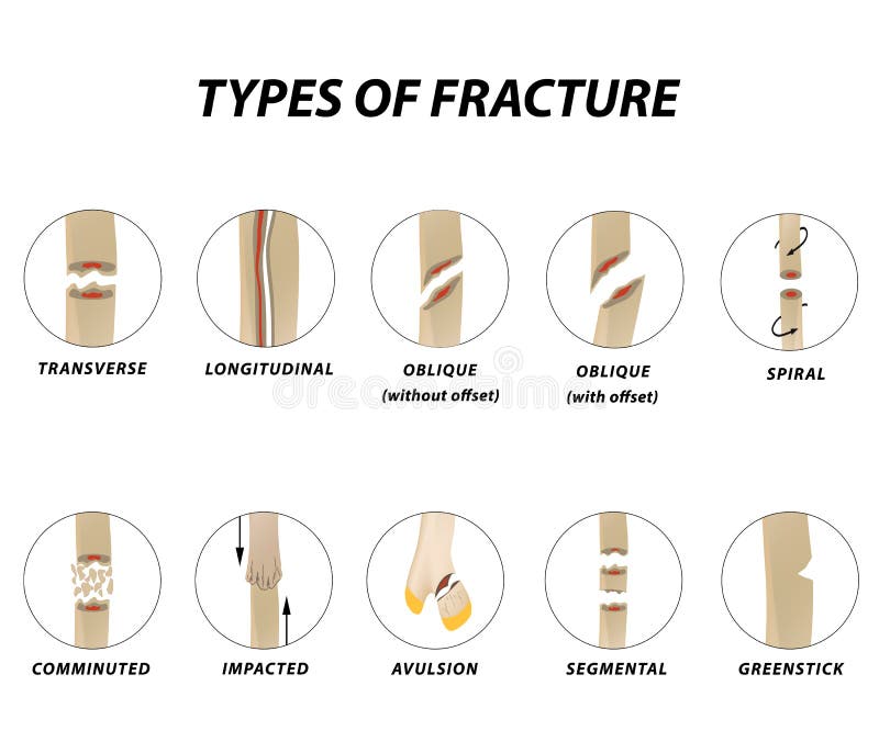 Types of Fracture. Fracture Bone Set. Infographics. Vector Illustration ... Types of Fracture. Fracture Bone Set. Infographics. Vector Illustration ...