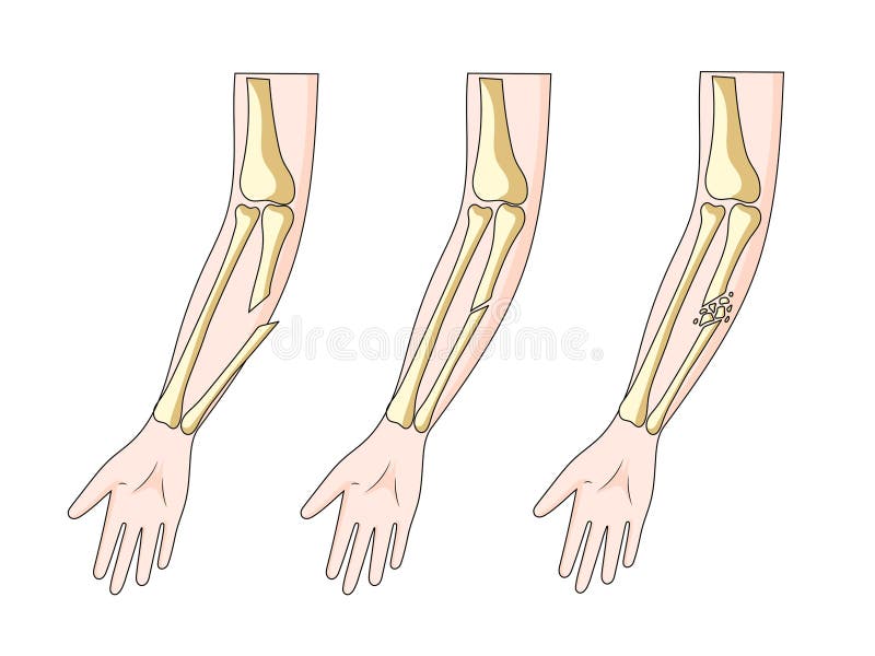 Types Bone Fractures Stock Illustrations – 46 Types Bone Fractures ... Types Bone Fractures Stock Illustrations – 46 Types Bone Fractures ...