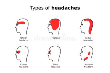 Types of Headaches Vector Infographic Stock Vector - Illustration of ...