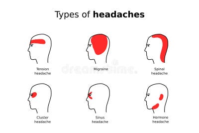 Types of Headaches Vector Infographic Stock Vector - Illustration of ...
