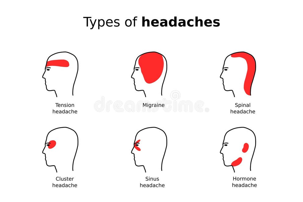 Types of Headaches Vector Infographic Stock Vector - Illustration of ...