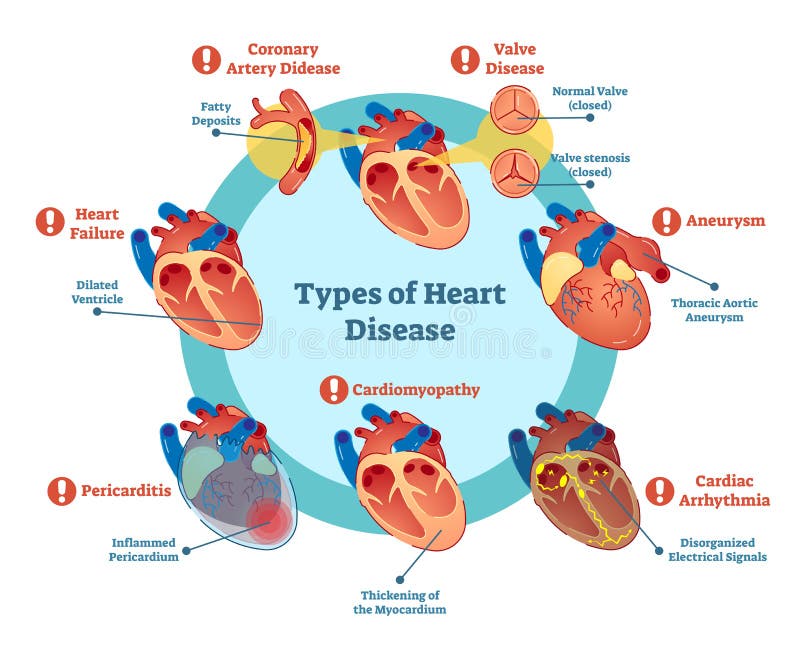 Types Of Heart Disease Collection Vector Illustration Diagram Educational Medical Information
