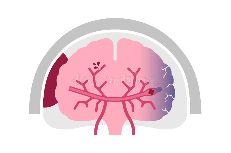 Types of Human Brain Stroke Vector Illustration Stock Vector ...