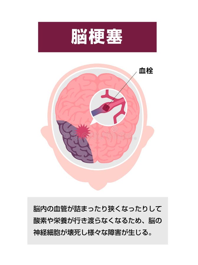 Types of Human Brain Stroke Vector Illustration | Cerebral Infarction ...