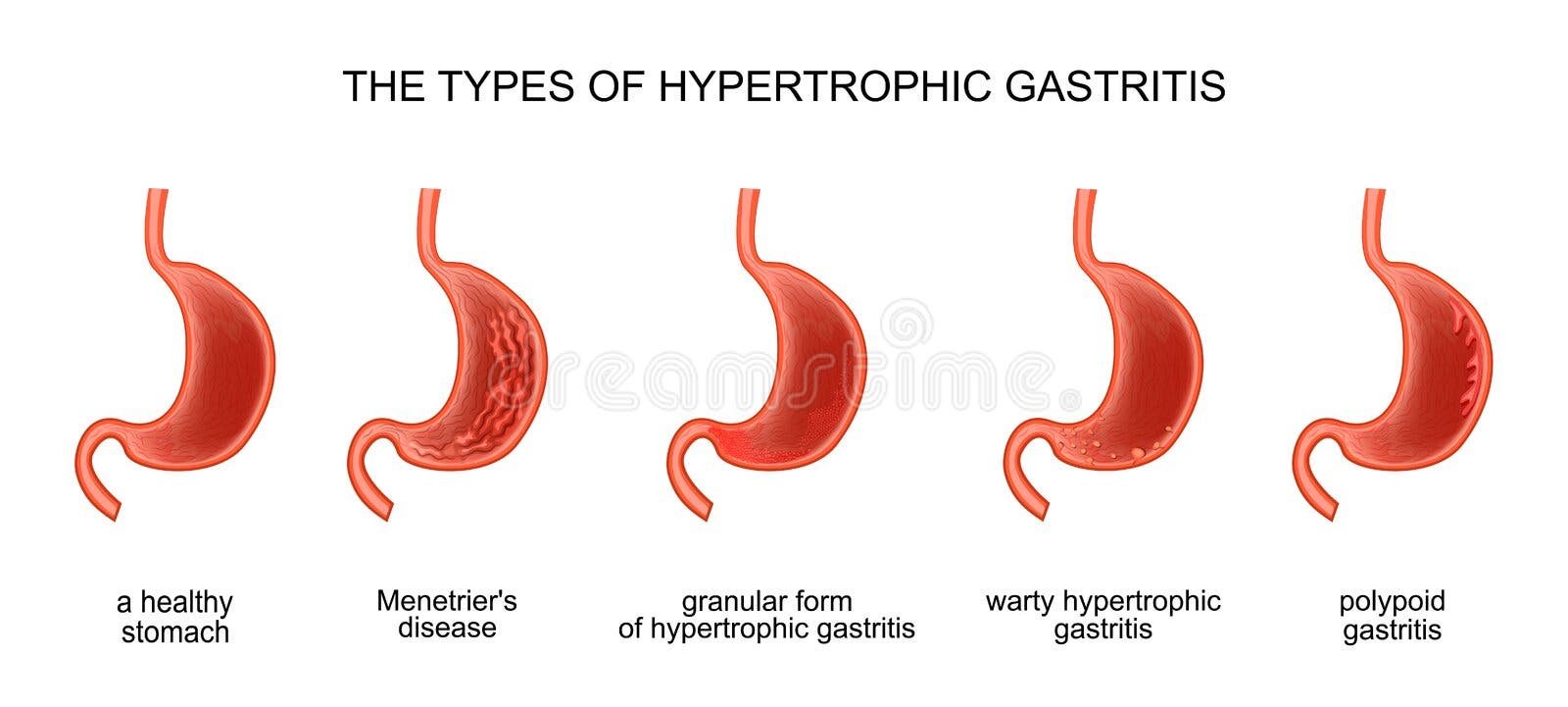 Types of Peptic Ulcer Stomach Disease Infographics Stock Vector ...