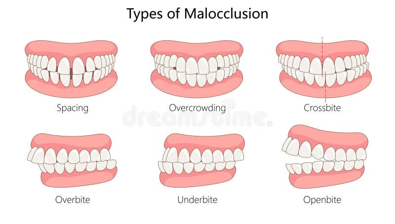 Types of Malocclusion Dental Diagram Medical Stock Illustration ...