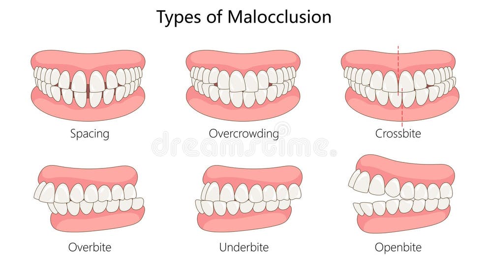 Types of Malocclusion Dental Diagram Medical Stock Vector ...