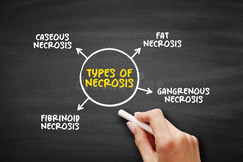 Types of Necrosis (death of Body Tissue) Mind Map Text Concept for ...