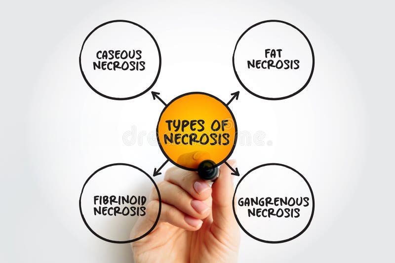 Types of Necrosis (death of Body Tissue) Mind Map Text Concept for ...
