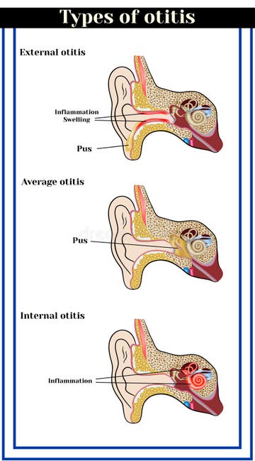 Pinna Cartilage Stock Illustrations – 34 Pinna Cartilage Stock ...