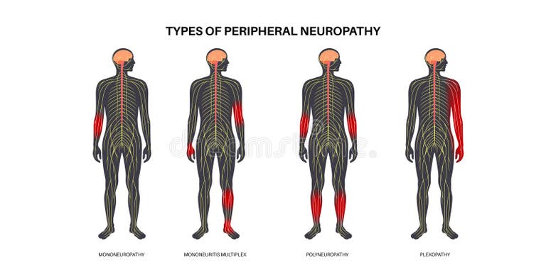 Peripheral Neuropathy Medical Poster Stock Vector - Illustration of ...