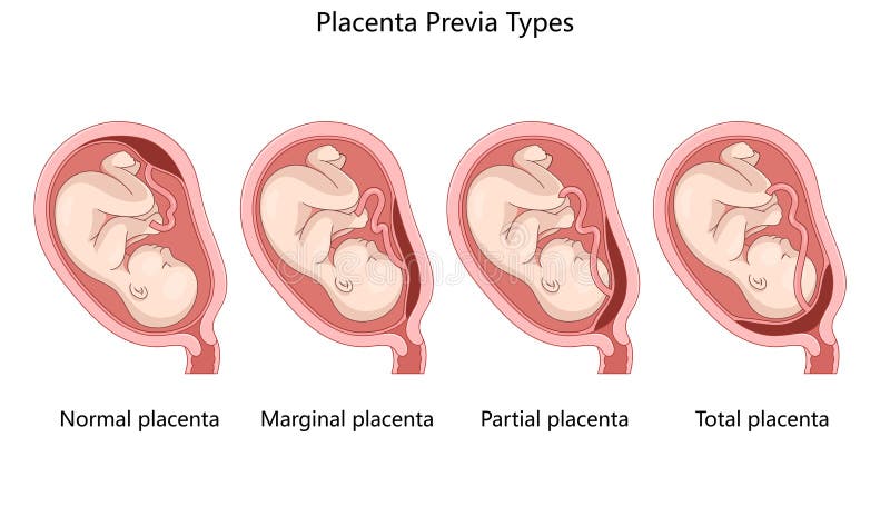 Types of Placenta Previa Diagram Medical Science Stock Illustration ...