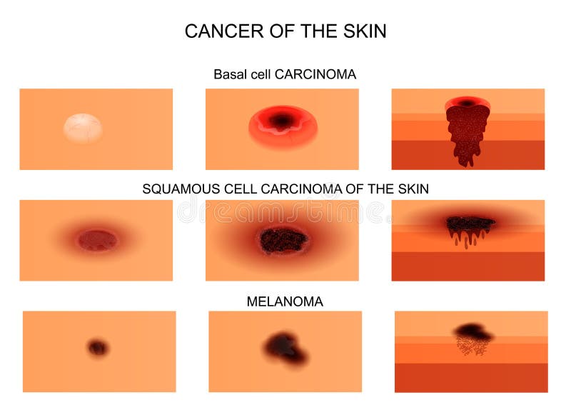 Infographic Showing Some Sarcoma Types and Principal Affected Tissues ...
