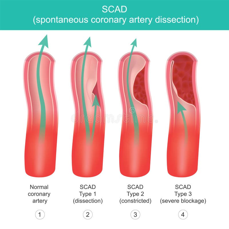 SCAD Illustrates stock vector. Illustration of reduction - 392246712