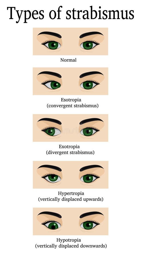 Strabismus Stock Illustrations – 280 Strabismus Stock Illustrations ...