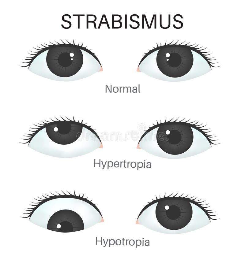 Types of strabismus-1 stock vector. Illustration of optical - 136471526