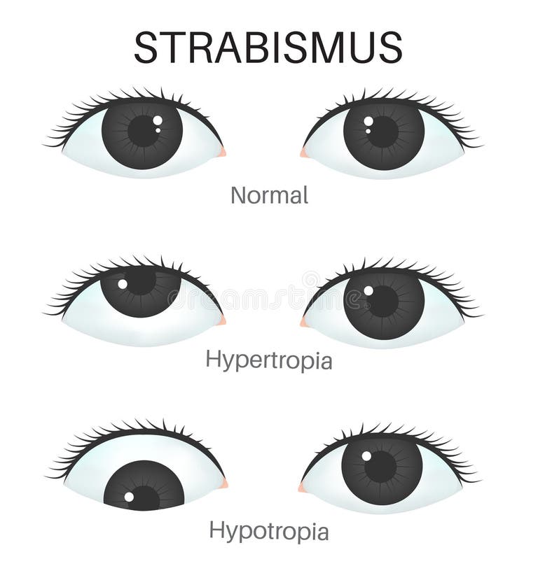 Eye Deviation Stock Illustrations – 133 Eye Deviation Stock ...